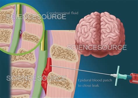 Epidural Blood Patch Procedure Illust Stock Image Science Source