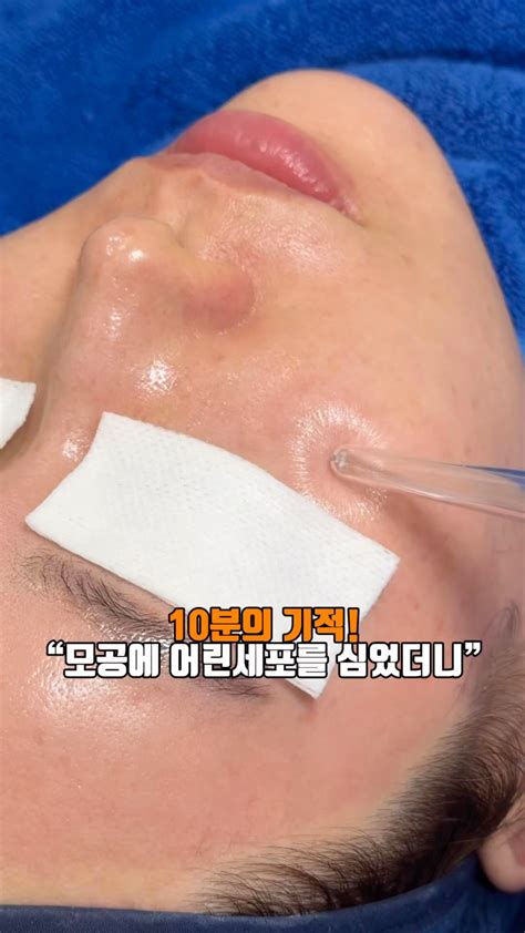부평피부 인천슈퍼젝션 피부환생연구소 쏘앤뷰티 돌고 돌아 결국엔 슈퍼젝션 피부를 깎는 자극적인 관리 울퉁불퉁한 인위적인 볼륨