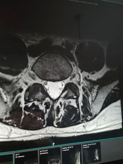 Left Psoas Trying To Run Away 😂 Rradiology