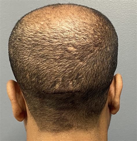 Plastic Surgery Case Study Male Occipital Bun Skull Reduction Explore Plastic Surgery