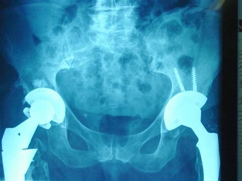 Osteomyelitis 10 Years After Knee Replacement Health Salud