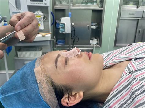 7年的时间，两次鼻修复，我来说说鼻整形的那些“后遗症” 知乎