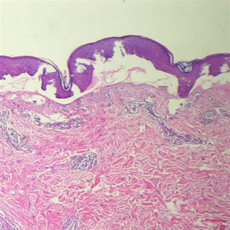 Tense Clear Fluid Filled Vesicles And Bullae On Erythematous Base With