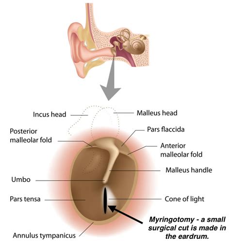 Middle Ear Effusion Explained Causes Symptoms And When To See A Doctor