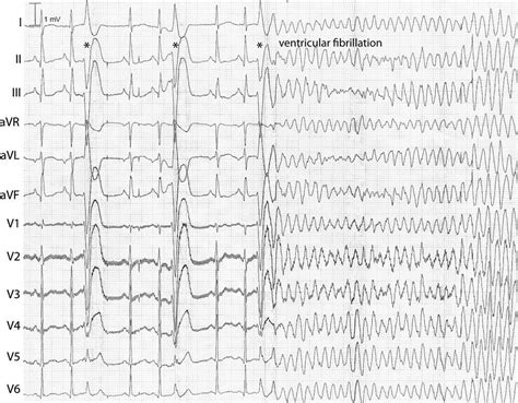 Ventricular Fibrillation Vf Ventricular Fibrillation Vf Msd Manual Professional Edition