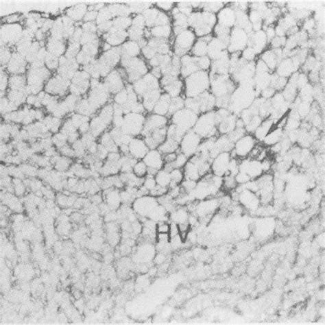 Strong Membranous Staining For Intercellular Adhesion Molecule I