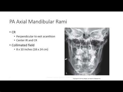 Radiographic Positioning Of The Mandible Youtube
