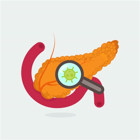 Pancreatic Cancer Illustrations Royalty Free Vector Graphics And Clip