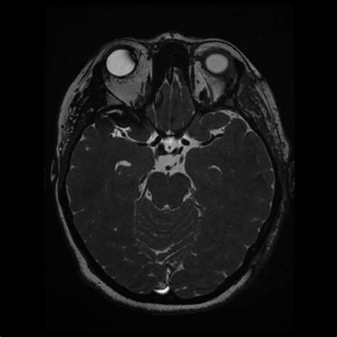 Neurovascular Compression Syndrome Trigeminal Nerve Radiopaedia 89835 106947 Axial Fiesta