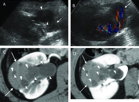 A 58 Year Old Perimenopausal Woman With A Mixed Epithelial And Stromal