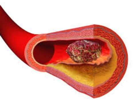 Difference Between Thrombosis And Embolism Relationship Between