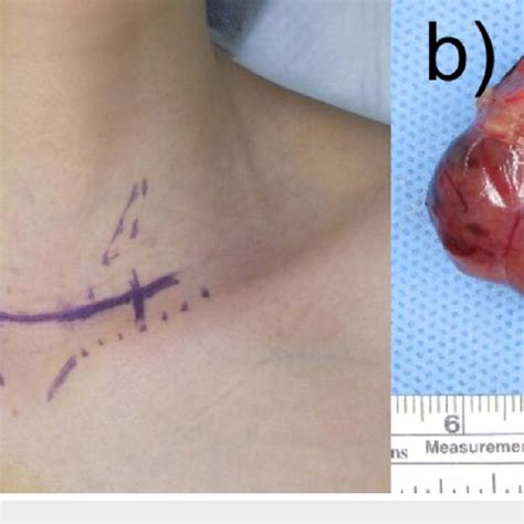Skin Incision Lines A And Excised Tissue B Download Scientific