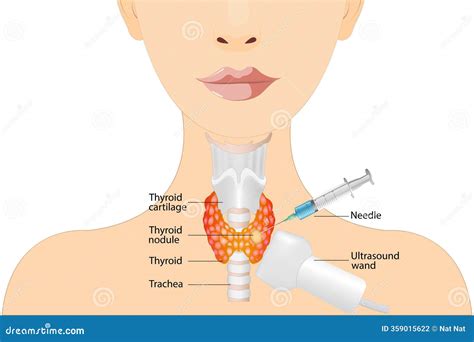 Fine Needle Aspiration Of Thyroid Nodules Vector Illustration