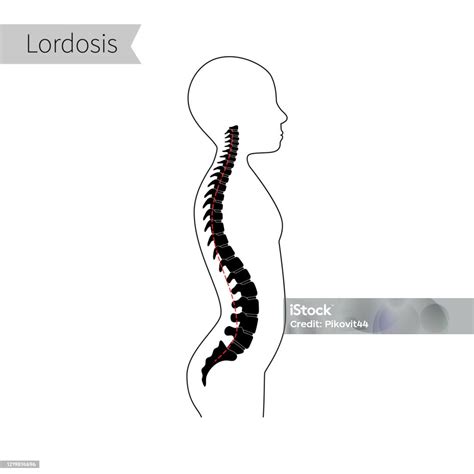 Lordosis Flat Vector Illustration Stock Illustration Download Image