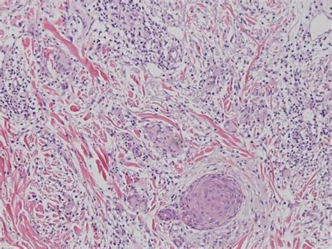 Skin Biopsy Showing Interstitial Granulomatous Dermatitis With A Few