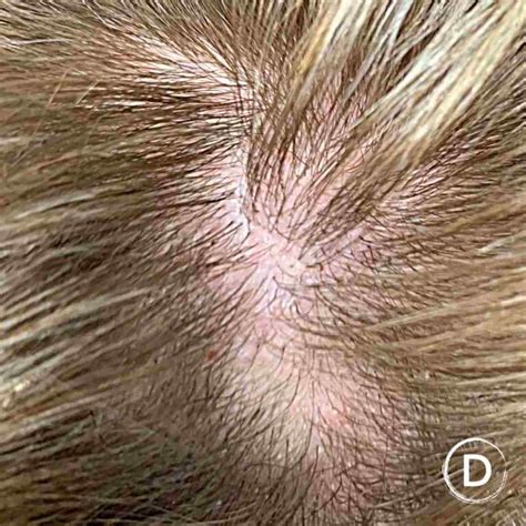 Lichen Planopilaris Nyc Frontal Fibrosing Alopecia Treatment In New