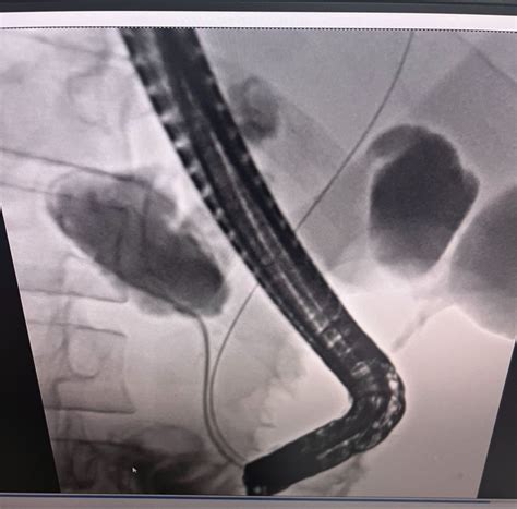 Dr Amit Joshi On Linkedin Ercp Giendoscopy