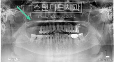 임플란트 고난이도 상악동 뼈이식 잇몸물혹잇몸뼈물혹 제거 및 뼈이식 Prf 임플란트 네이버 블로그