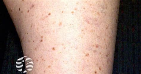 Lentigo Image