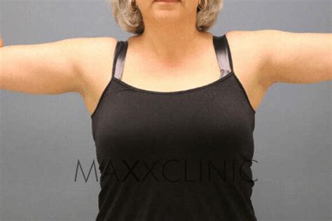 Maxxclinic Arm Lift Brachioplasty Good Better Maxx