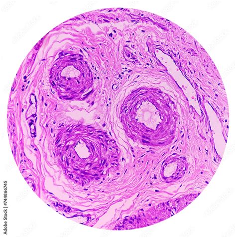 Uterus With Adnexa Biopsy Cervix Show Chronic Inflamatory Cells