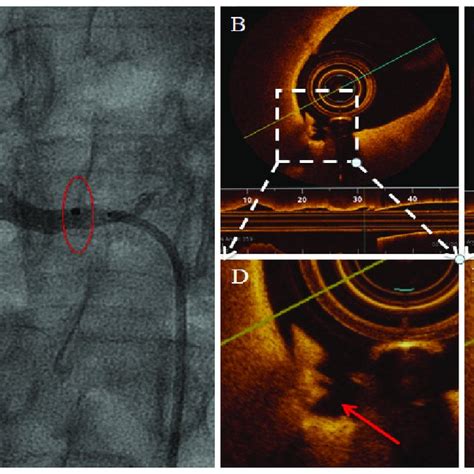 Intravascular Optical Coherence Tomography Ivoct Findings After Rdn Download Scientific