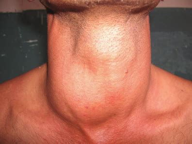 The Patient Presented Diffuse Smooth Swelling Of The Right Lobe Of The Download Scientific