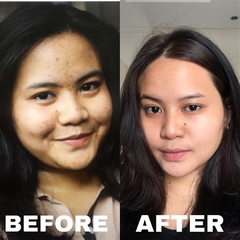 Acne Krim Apotik Kesehatan And Kecantikan Rias Wajah Di Carousell