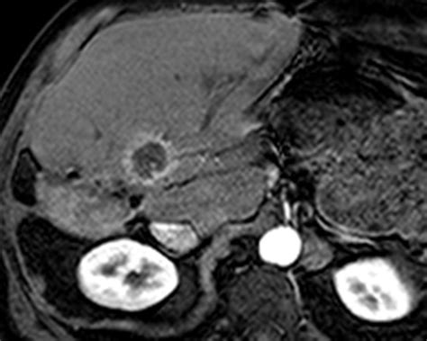 Liver Atlas Diagnosis Metastasis Cholangiocarcinoma