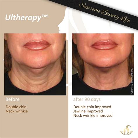 Ultherapy Faceneck Supreme Beauty Life