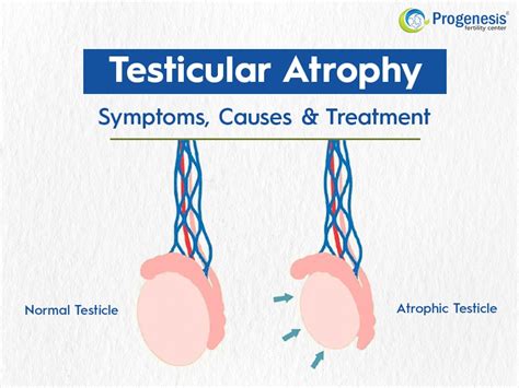Testicular Atrophy Symptoms Causes And Treatment