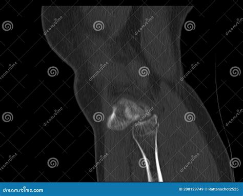 Scan Knee Fracture Of Intercondylar Eminence Of Tibia Compression Fracture Of Posterior Of
