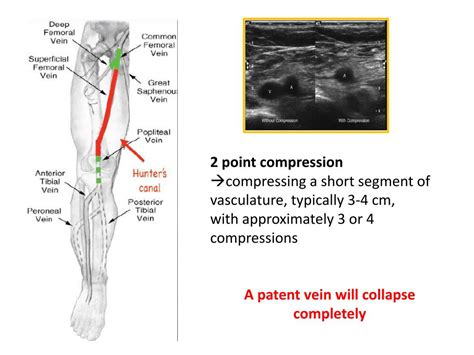 Ppt The Evaluation Of Dvt Bedside Ultrasound Diagnosis And Evaluation