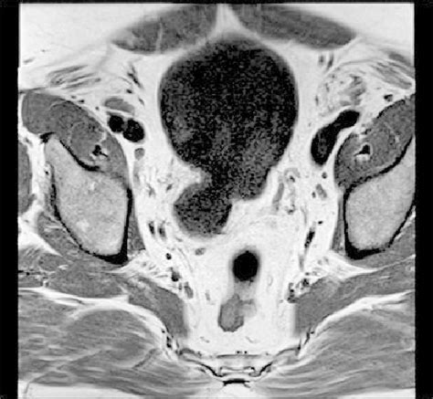 A Magnatic Resonance Imaging Mri Of The Pelvis Showing Bladder
