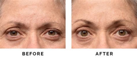 Sofwave Non Surgical Brow Lift Cranley Clinic Harley Street London