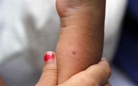 The Best Essential Oils For Bug Bites And Insect Repellent