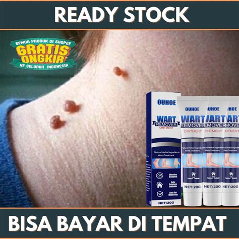Ubat Ketuat Tahi Lalat Remover Buang Tahi Lalat Dan Kutil Biji