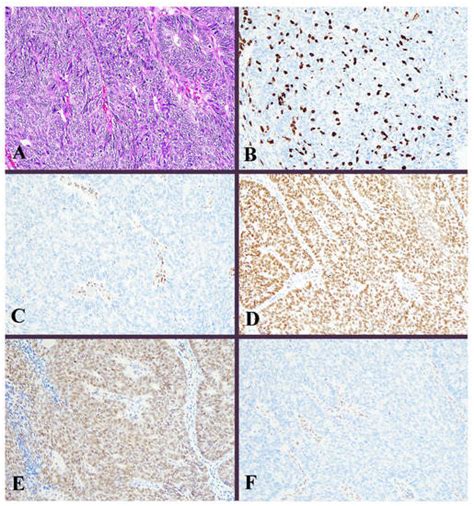 Diagnostics Free Full Text Tumor Infiltrating Cd8 Positive T Cells Associated With Mmr And
