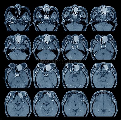 Mri Brain And Orbit Showing Circumscribed Expansile Growth Lesion