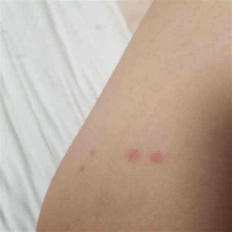 대상포진 일까요 사진 확인부탁 드립니다 ㅣ 궁금할 땐 아하