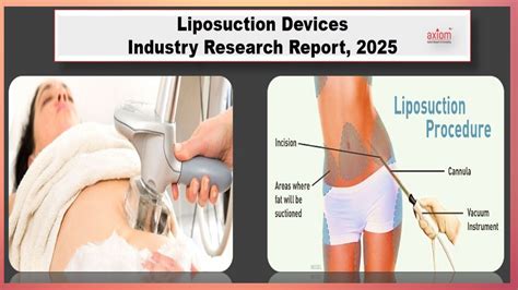 Liposuction Devices Market Development By Production Technology Latest