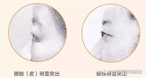 眼睛凸的双眼皮手术怎么做？ 知乎