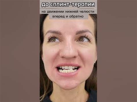 сплинт-терапия - YouTube