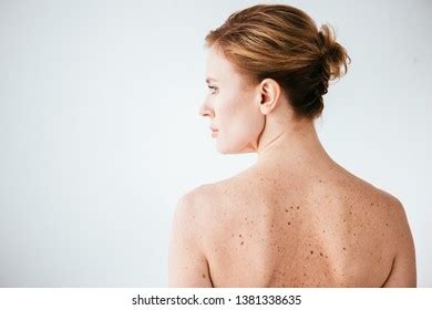 Стоковая фотография 1381338635 Attractive Naked Woman Skin Sickness On