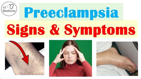 Preeclampsia Signs And Symptoms You Have To Watch Out For Youtube