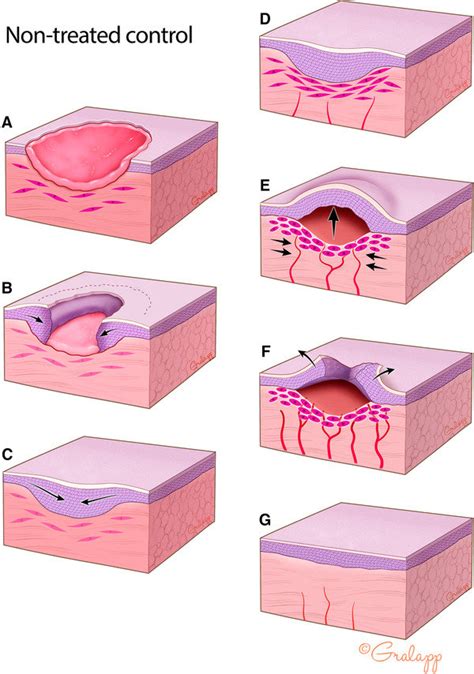 Tonsillectomy Healed Tonsillectomy Including Coblation Tonsillectomy