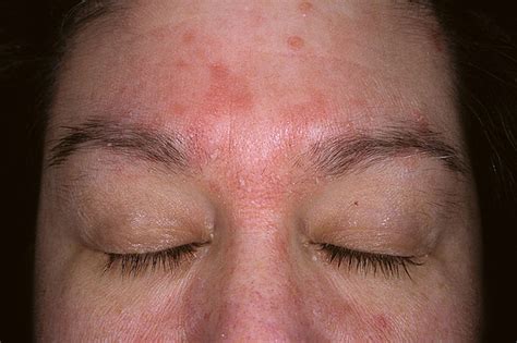 Seborrheic DermatitisSkin Care Brazilian And Bikini Waxing Facial