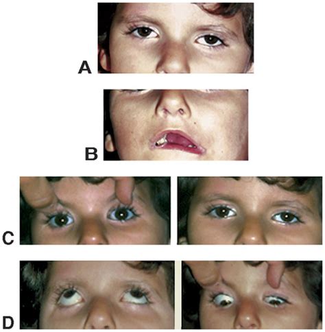 Congenital Eye Conditions Flashcards Quizlet
