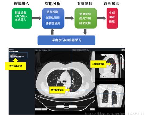 基于深度学习的ct图像肺结节自动检测技术（行业及技术分析）深度学习进行肺结节识别的过程 Csdn博客