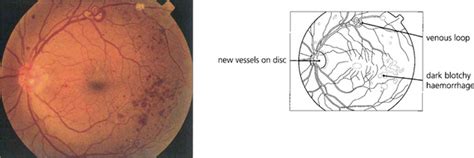 The Retina Vascular Diseases Ii Ento Key